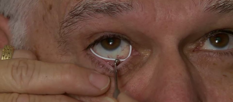 A TOPICAL OCULAR RING DESIGNED TO REPLACE GLAUCOMA EYE DROPS ...