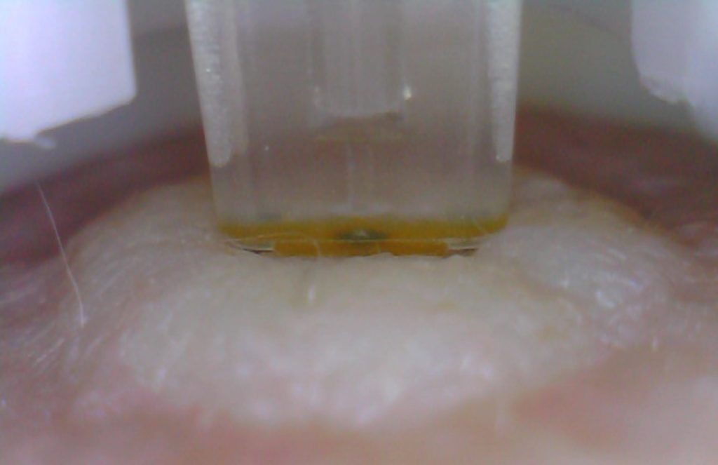 YOUR SOLUTION FOR SUCCESSFUL INTRADERMAL DELIVERY - ONdrugDelivery