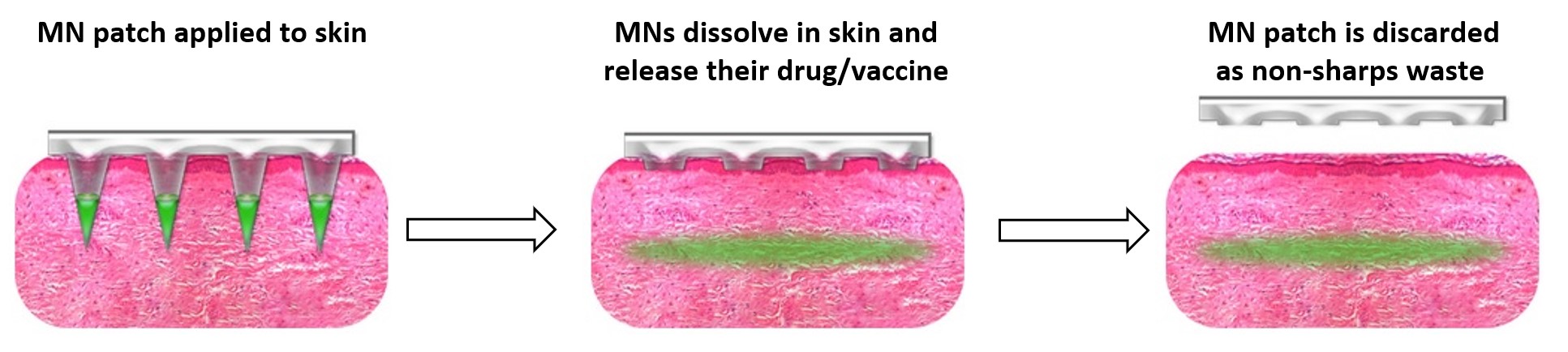 SIMPLIFIED DRUG AND VACCINE DELIVERY USING MICRON’S MICRONEEDLE PATCH ...