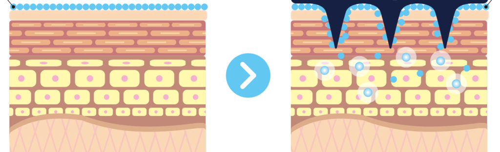 DISSOLVABLE MICRONEEDLES: APPLICATIONS AND OPPORTUNITIES - ONdrugDelivery