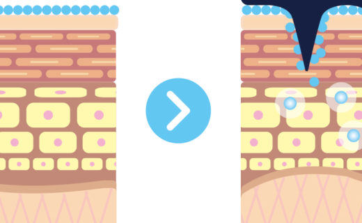 YOUR SOLUTION FOR SUCCESSFUL INTRADERMAL DELIVERY - ONdrugDelivery