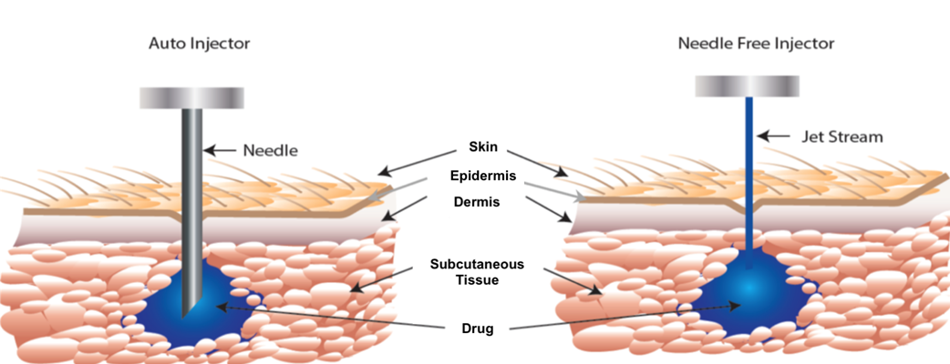 AN INJECTION OF CONNECTED NEEDLE-FREE INNOVATION - ONdrugDelivery