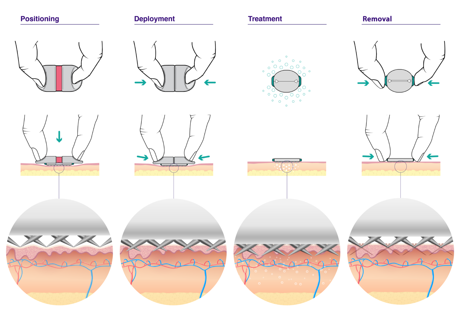 AN ANGLED MICRONEEDLE PATCH FOR ENHANCED DRUG AND VACCINE DELIVERY ...