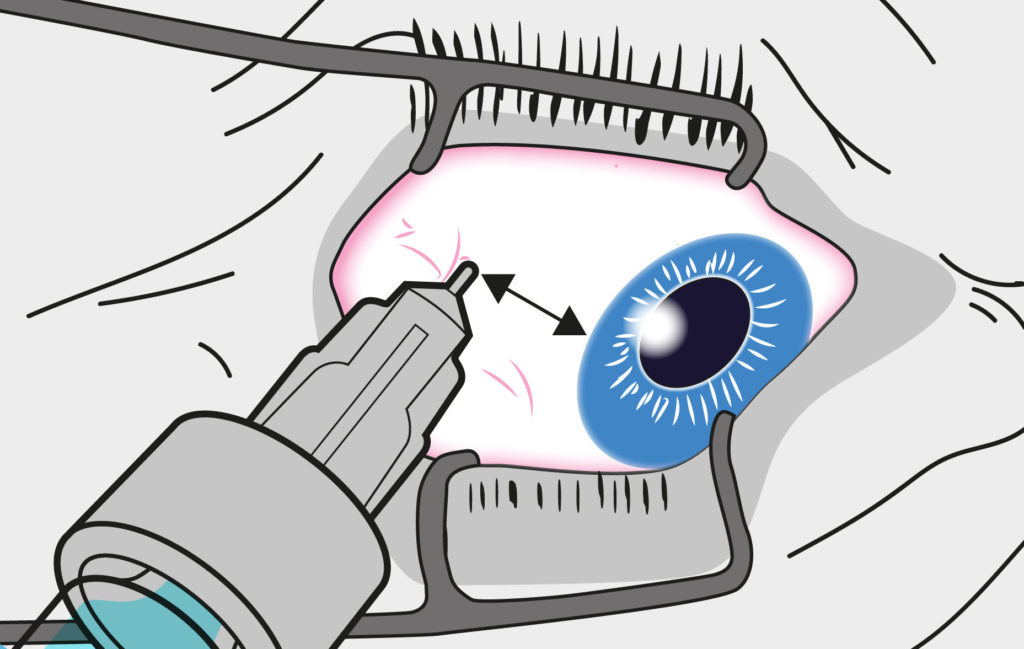 DRUG DELIVERY TO THE EYE: OVERCOMING THE CHALLENGES OF INTRAVITREAL ...