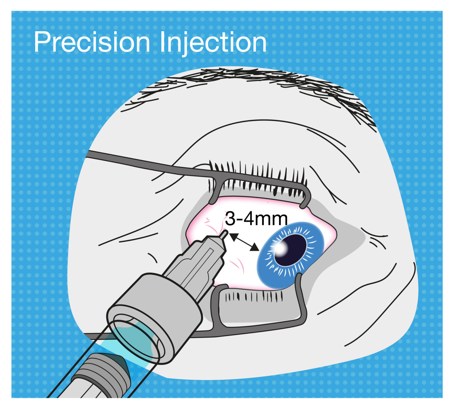 DRUG DELIVERY TO THE EYE: OVERCOMING THE CHALLENGES OF INTRAVITREAL ...