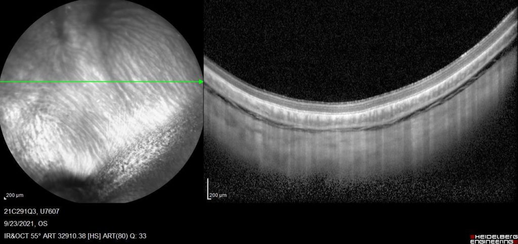 A NEW PLATFORM FOR SUPRACHOROIDAL DRUG DELIVERY USING STANDARD NEEDLES ...