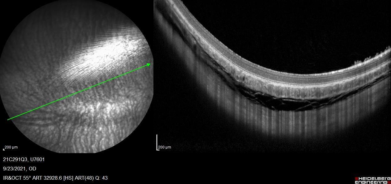 A NEW PLATFORM FOR SUPRACHOROIDAL DRUG DELIVERY USING STANDARD NEEDLES ...