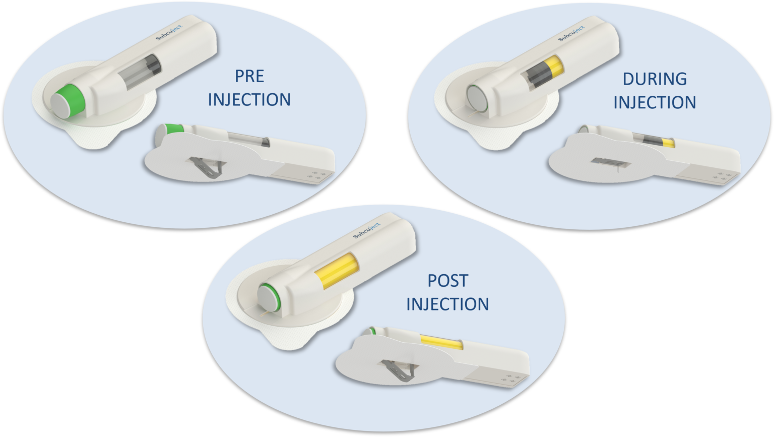 LOW-COMPLEXITY, EASY-TO-USE WEARABLE INJECTION PLATFORM | ONdrugDelivery