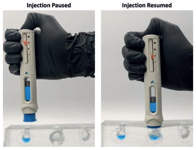 NEXT-GENERATION AUTOINJECTOR PLATFORM FOR HIGH-DOSE DRUGS - ONdrugDelivery