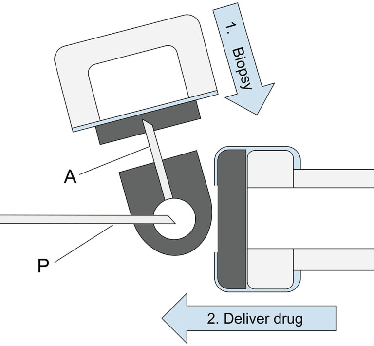 ACQUIRING A LIQUID BIOPSY INCIDENTAL TO INTRAVITREAL INJECTION ...