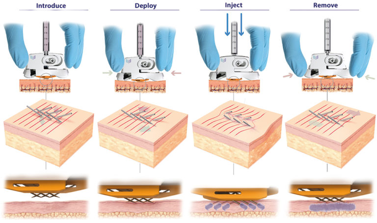 HOW DO YOU PERCEIVE INTRADERMAL DELIVERY? THINK AGAIN… - ONdrugDelivery