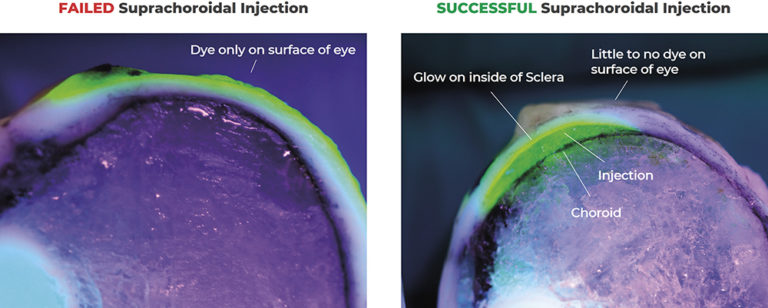 A NEW DELIVERY PLATFORM FOR SUPRACHOROIDAL ADMINISTRATION USING WEST’S ...